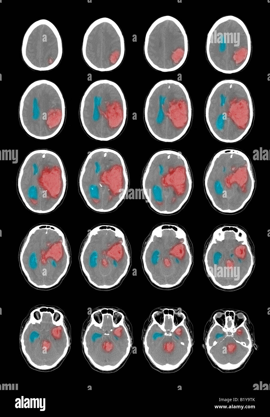 CT-Scan zeigt Intrazerebrale Blutung in die linke Temporoparietal ...