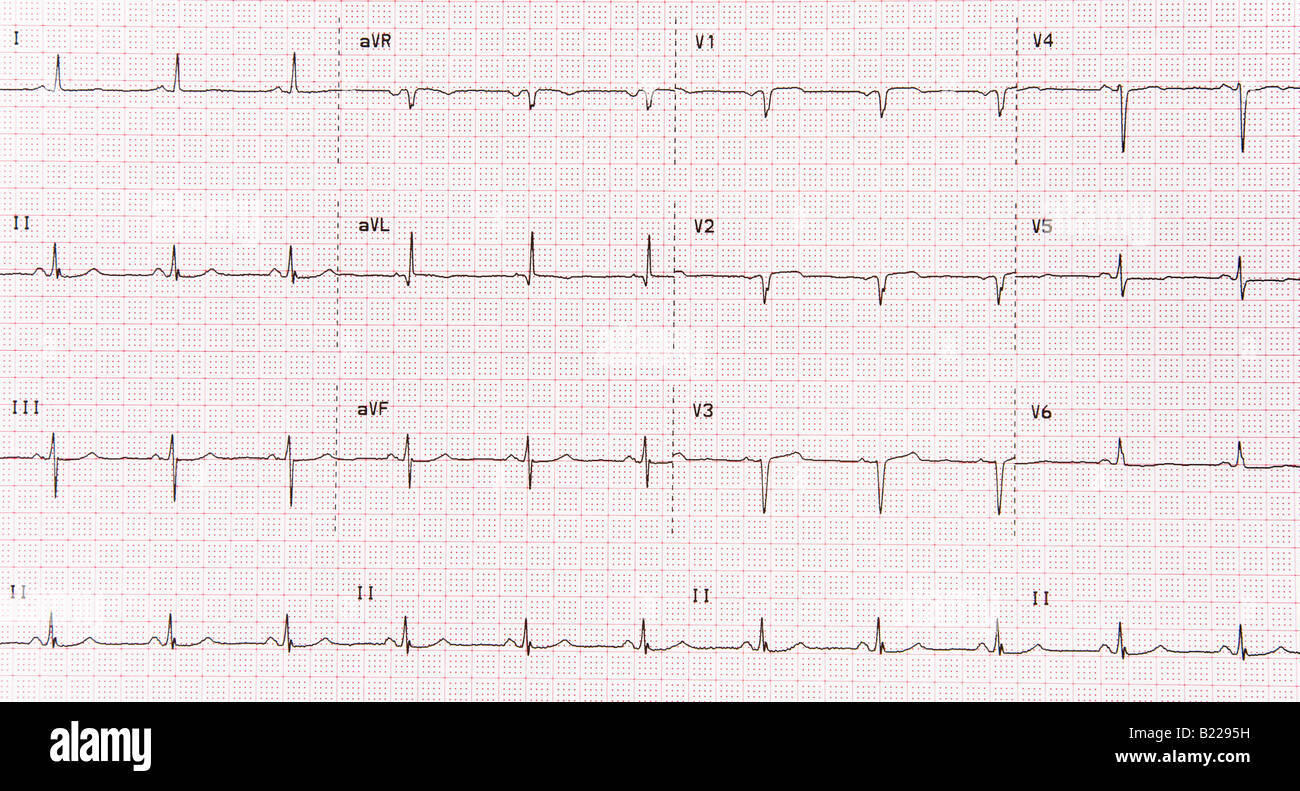 Ein Elektrokardiogramm 12 Blei oder EKG, zeigt einen Herzrhythmus des ...