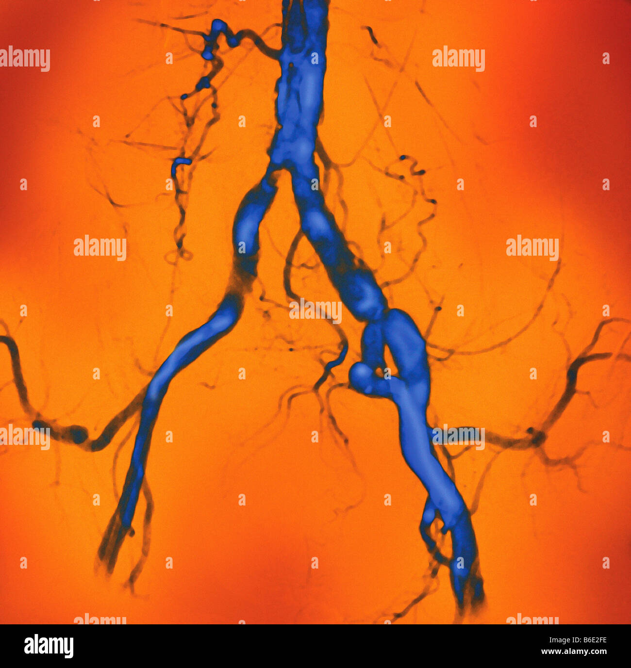 Angiogramm der bauchaorta -Fotos und -Bildmaterial in hoher Auflösung ...