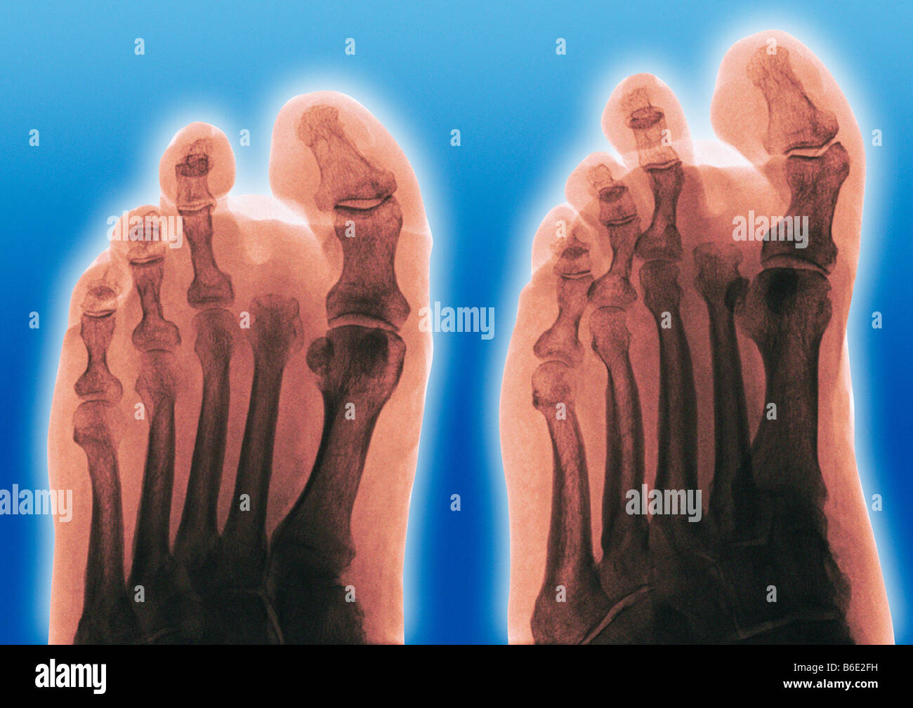 Amputierte Zehen. Farbigen frontal (links) und oblique(right) Röntgen ...