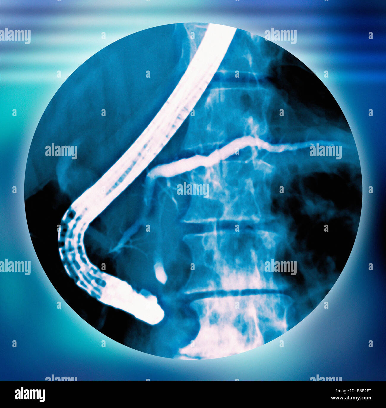 Endoskopische retrograde cholangiographie -Fotos und -Bildmaterial in ...
