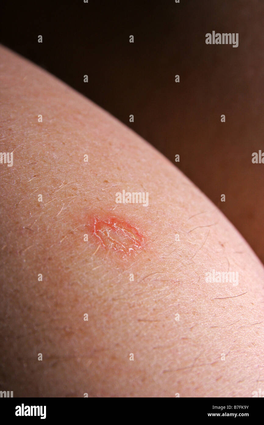 Hautinfektion mit dermatophyten Stockfotos und -bilder Kaufen - Alamy