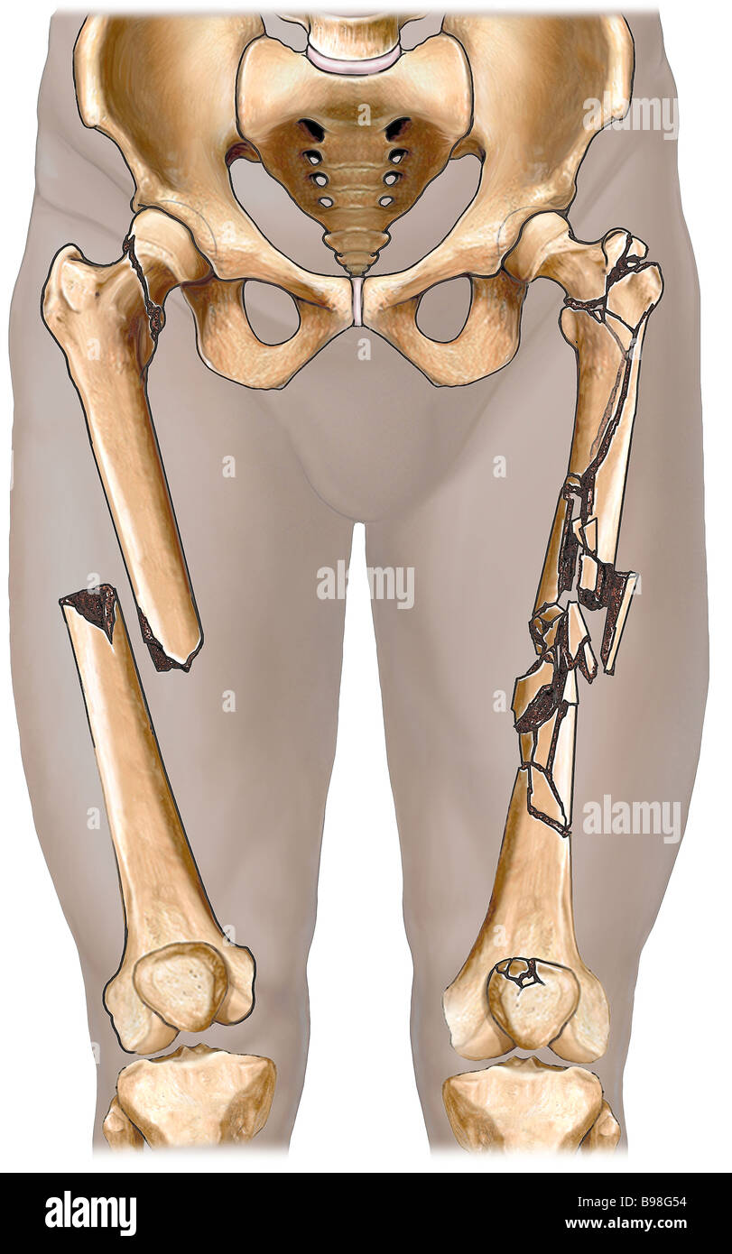 Broken femur -Fotos und -Bildmaterial in hoher Auflösung – Alamy