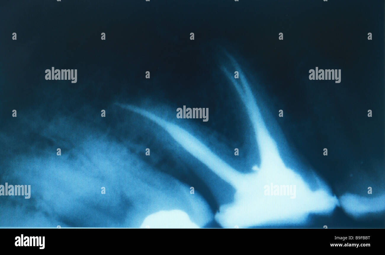 Molar tooth -Fotos und -Bildmaterial in hoher Auflösung – Alamy