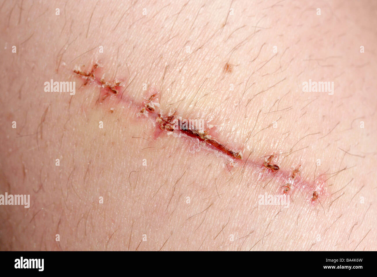 Narbe haut -Fotos und -Bildmaterial in hoher Auflösung – Alamy