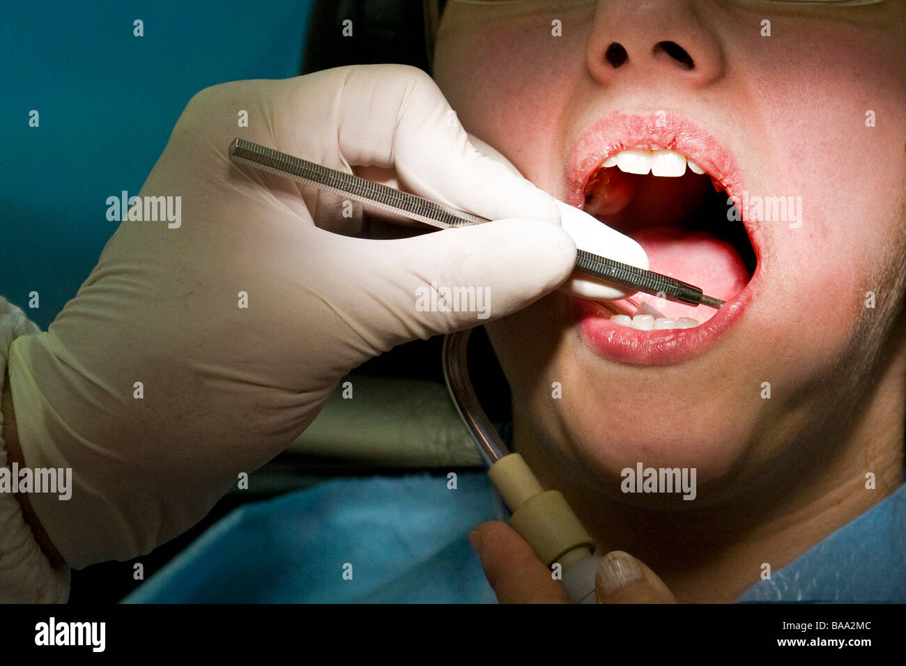 Zahnarzt weit offen -Fotos und -Bildmaterial in hoher Auflösung – Alamy