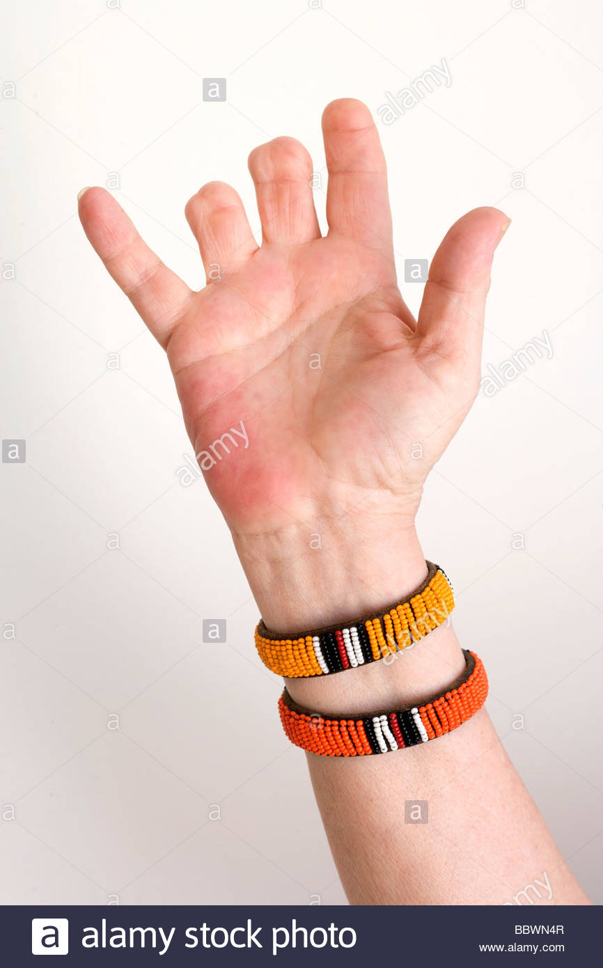 Missing Finger Stockfotos & Missing Finger Bilder - Alamy