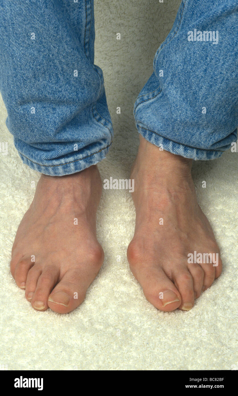 Krumme füße -Fotos und -Bildmaterial in hoher Auflösung – Alamy