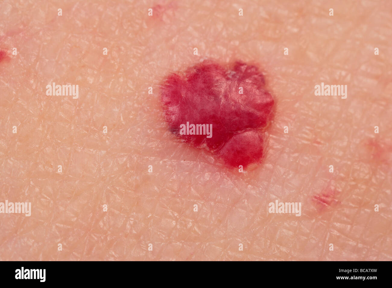 Eine Nahaufnahme von einer Kirsche Angiom Stockfotografie - Alamy