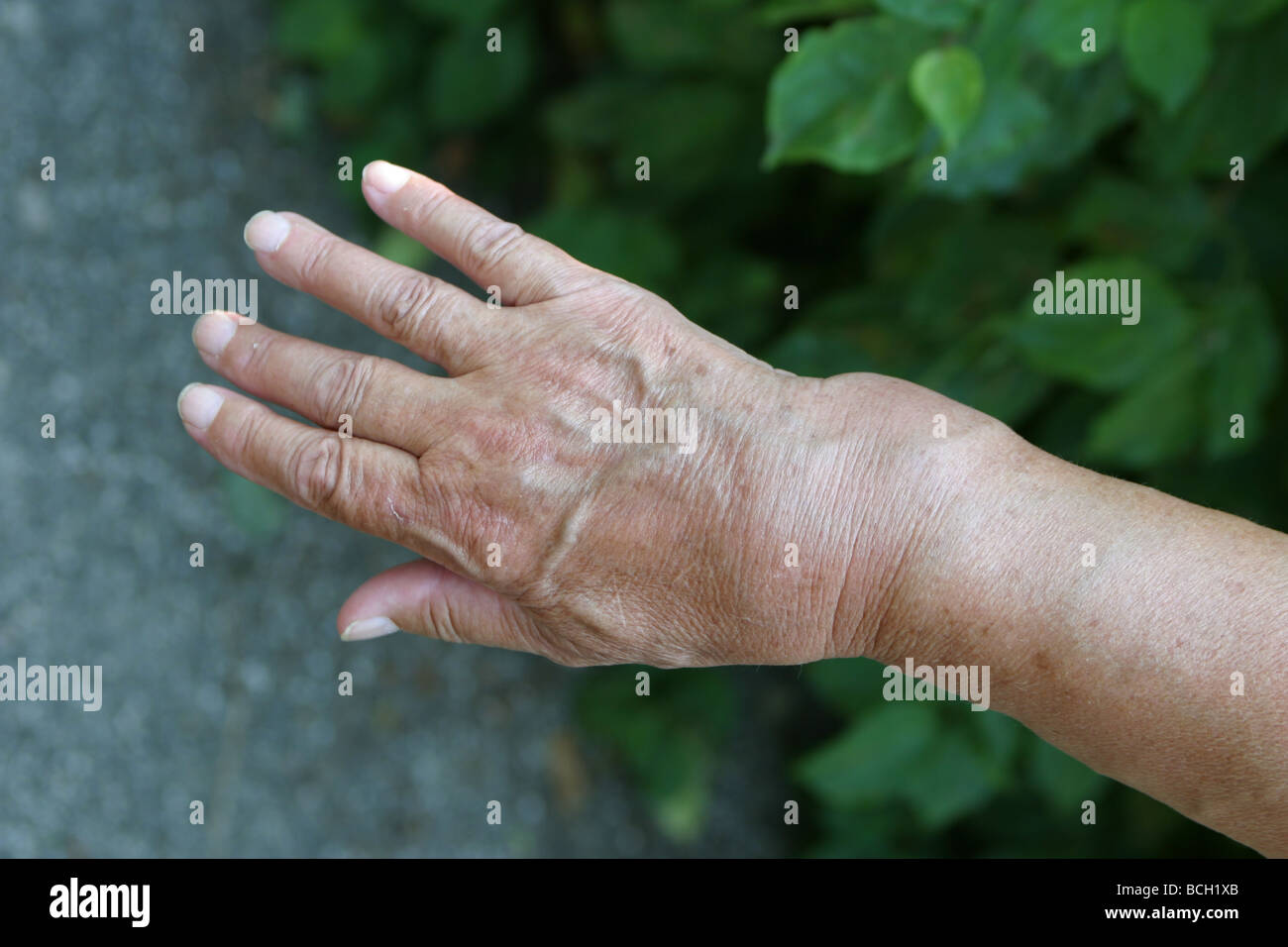 Unterarm und handgelenksverletzungen -Fotos und -Bildmaterial in hoher ...