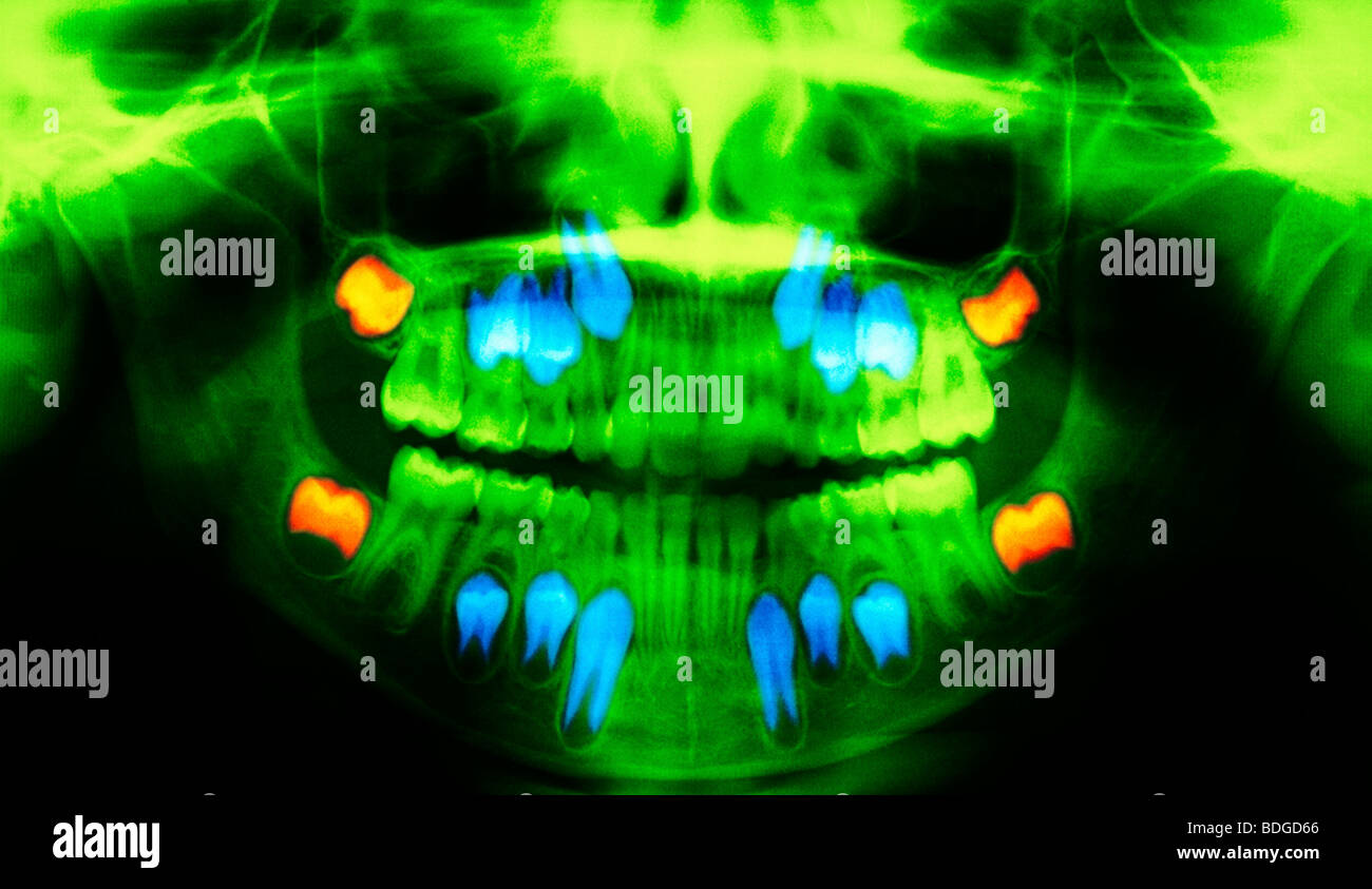 Teeth x ray baby -Fotos und -Bildmaterial in hoher Auflösung – Alamy