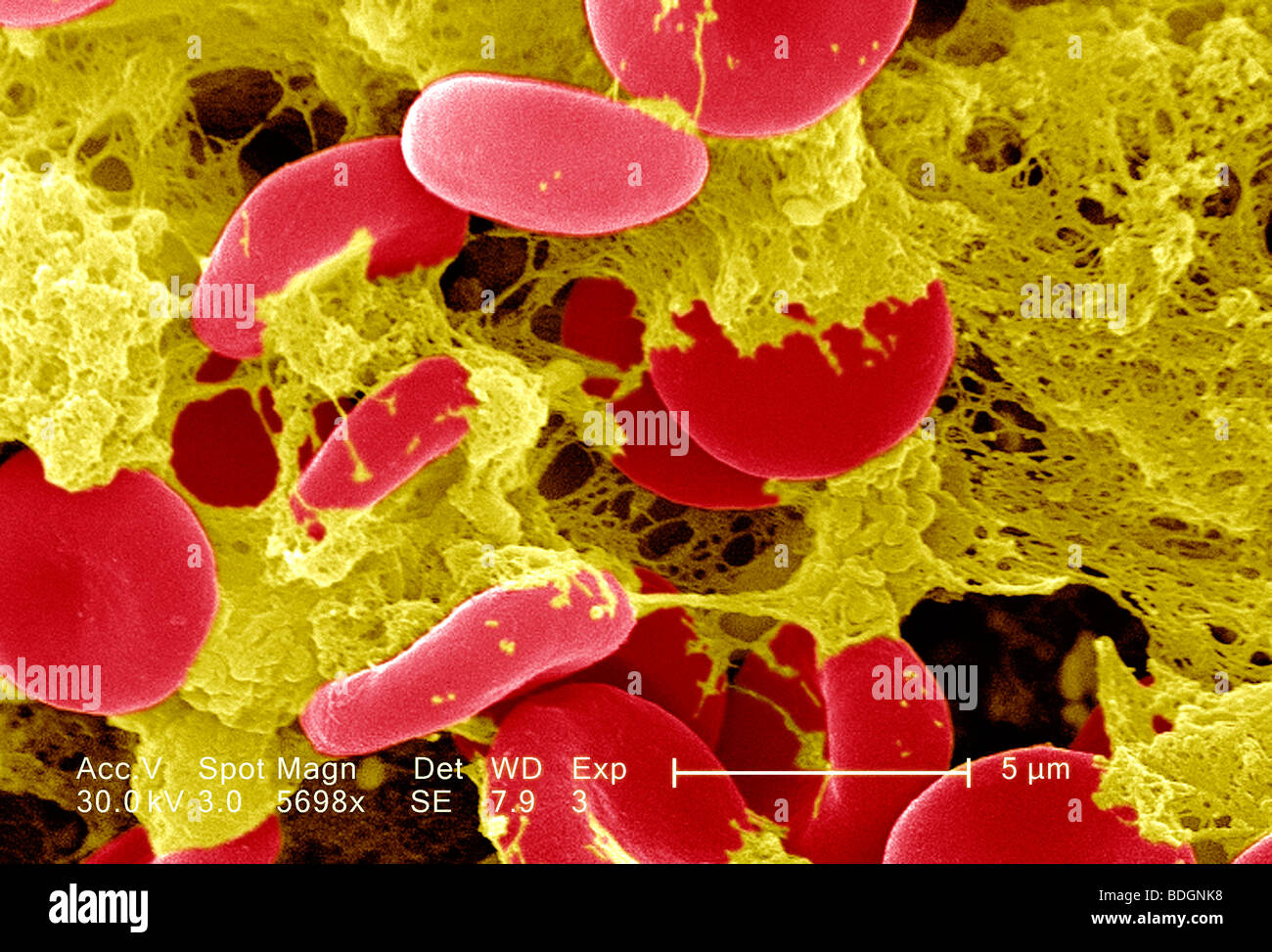 Koagulum fibrin -Fotos und -Bildmaterial in hoher Auflösung – Alamy