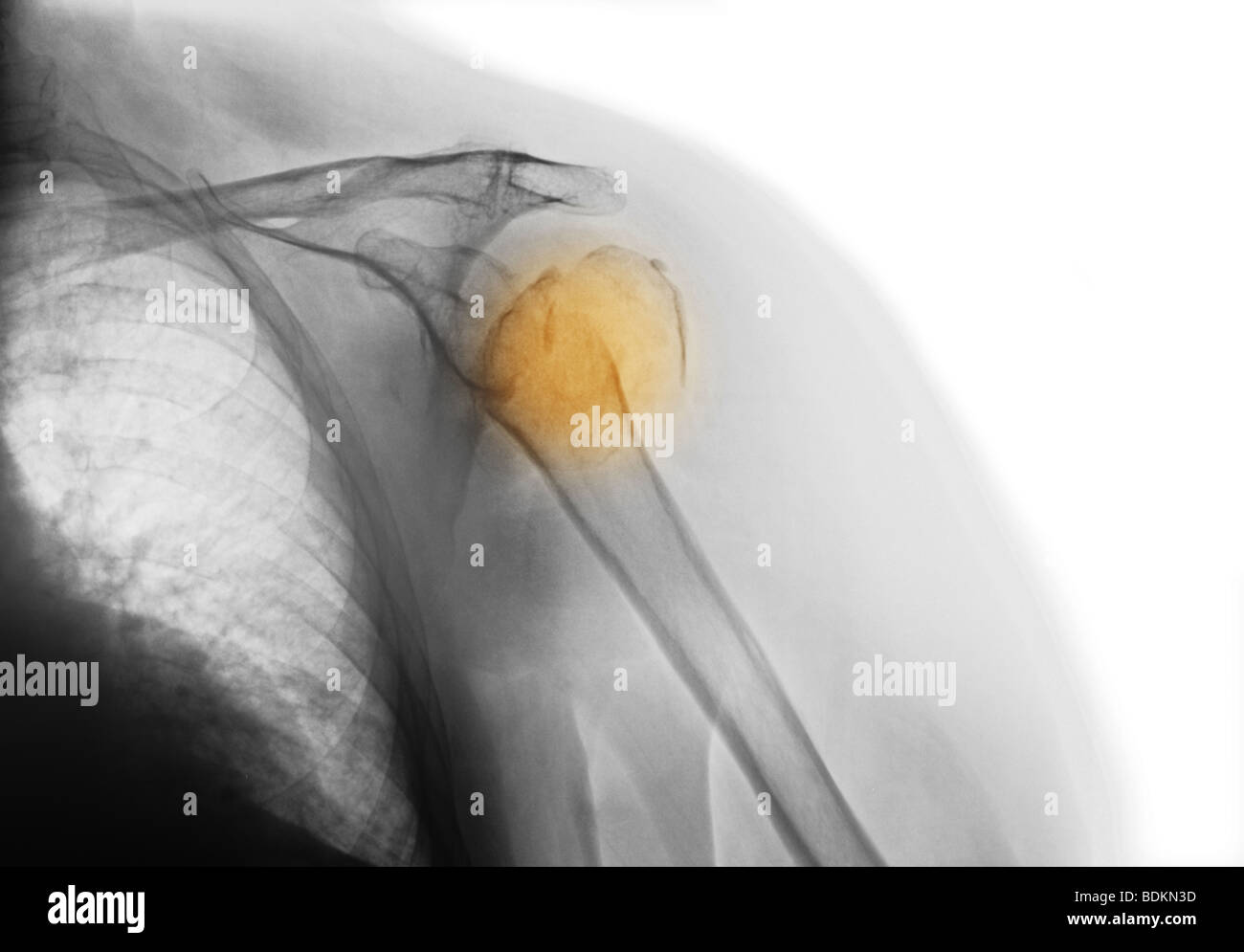 Röntgen der Schulter eine 81 Jahre alte Frau mit Osteoporose zeigt eine ...