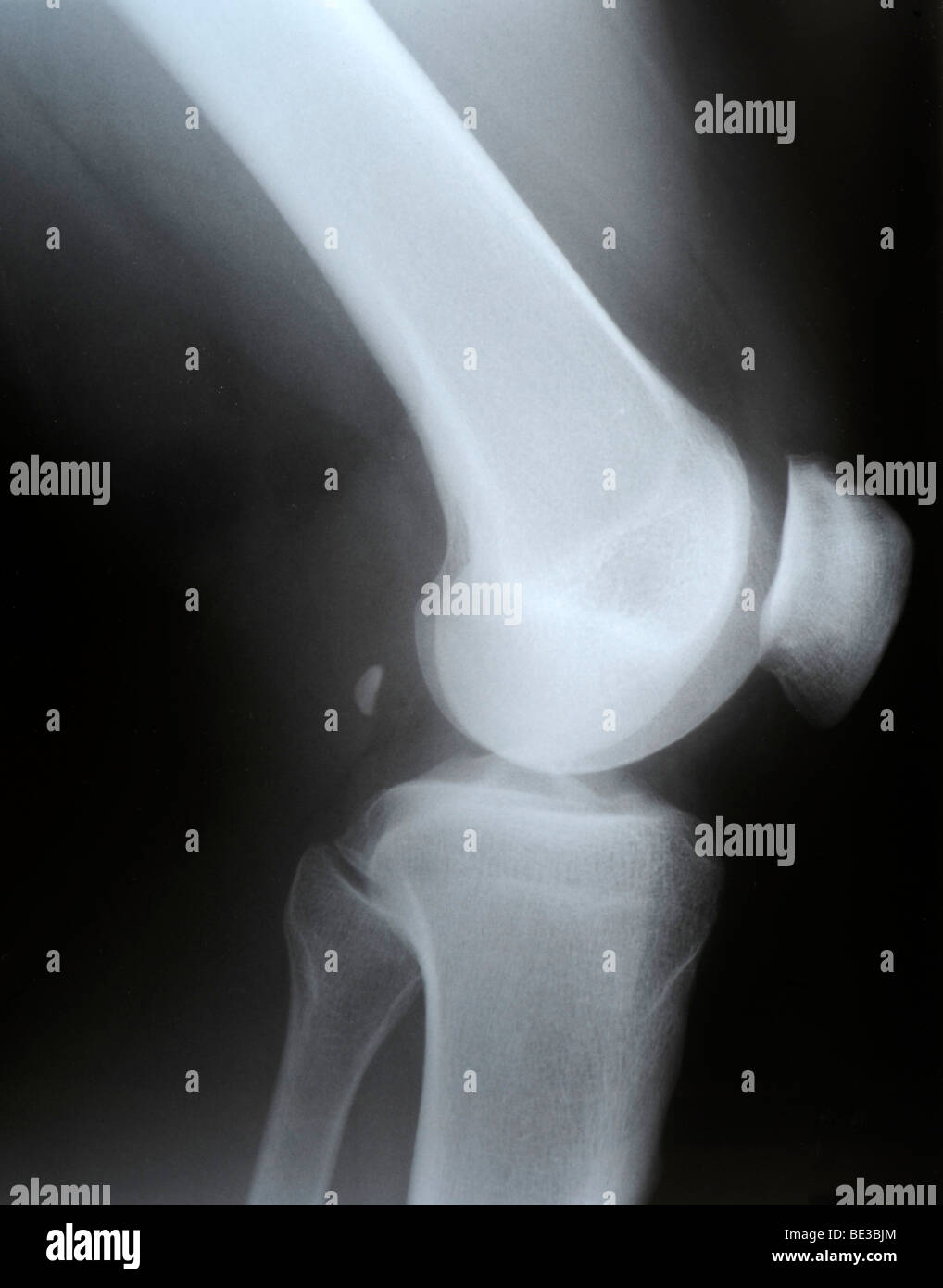 X ray knee lateral -Fotos und -Bildmaterial in hoher Auflösung – Alamy