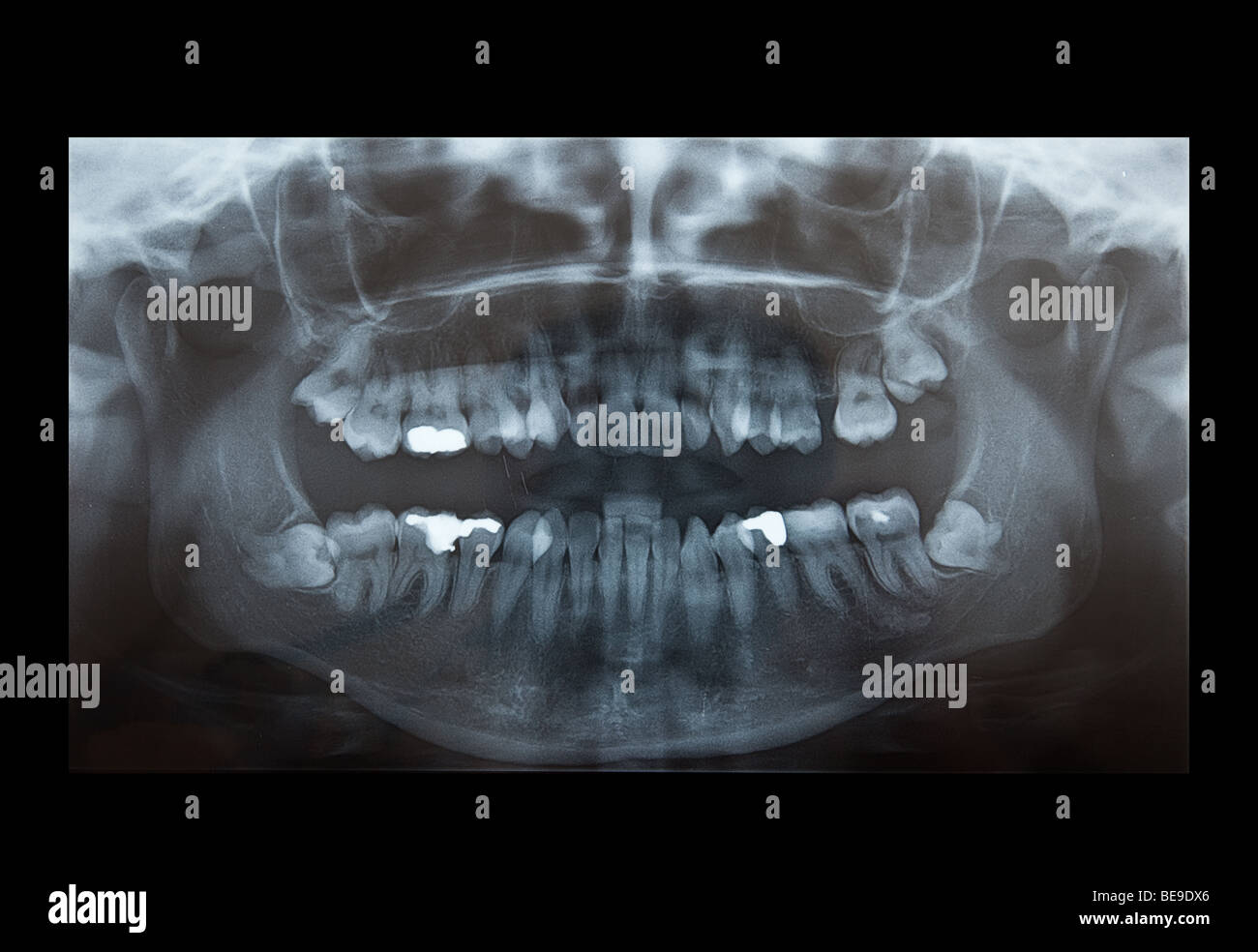 Teeth extraction -Fotos und -Bildmaterial in hoher Auflösung – Alamy