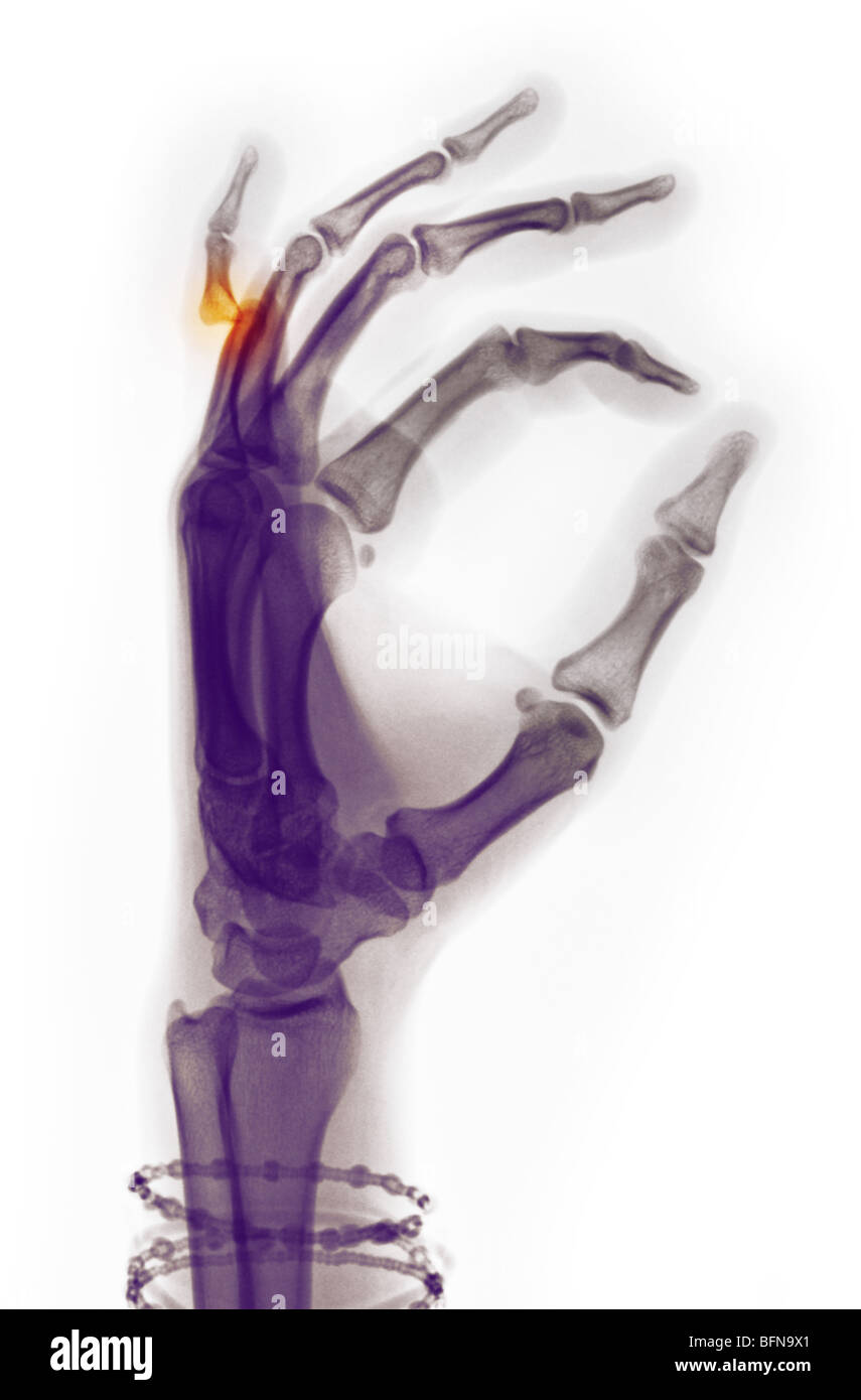 Luxation finger röntgen verrenkung -Fotos und -Bildmaterial in hoher ...