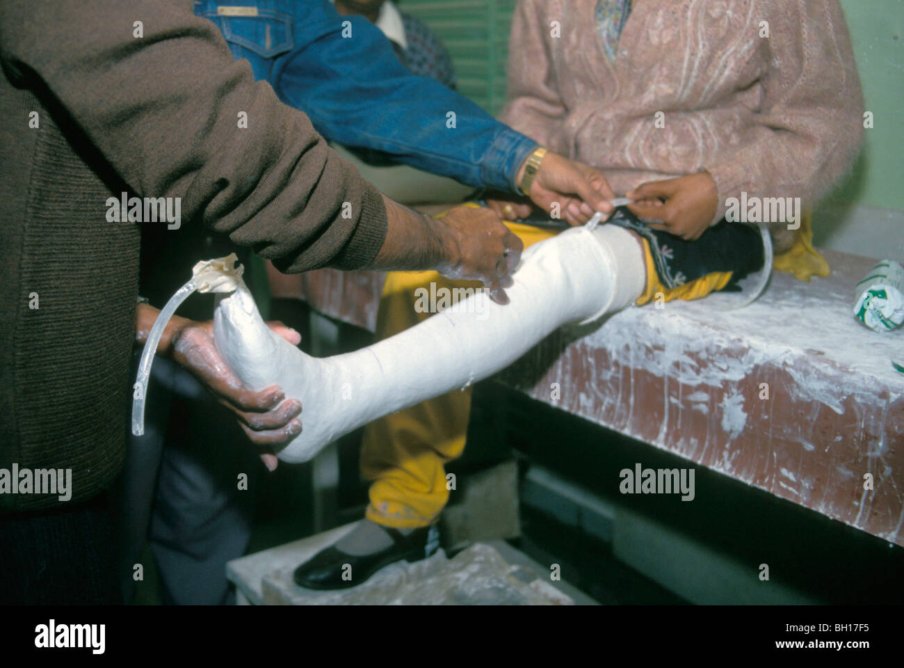 Prothese von indien -Fotos und -Bildmaterial in hoher Auflösung – Alamy