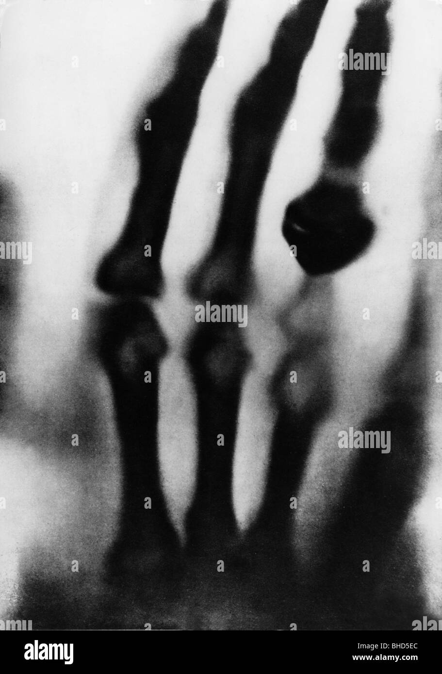 Radiograph Hand Stockfotos und -bilder Kaufen - Alamy