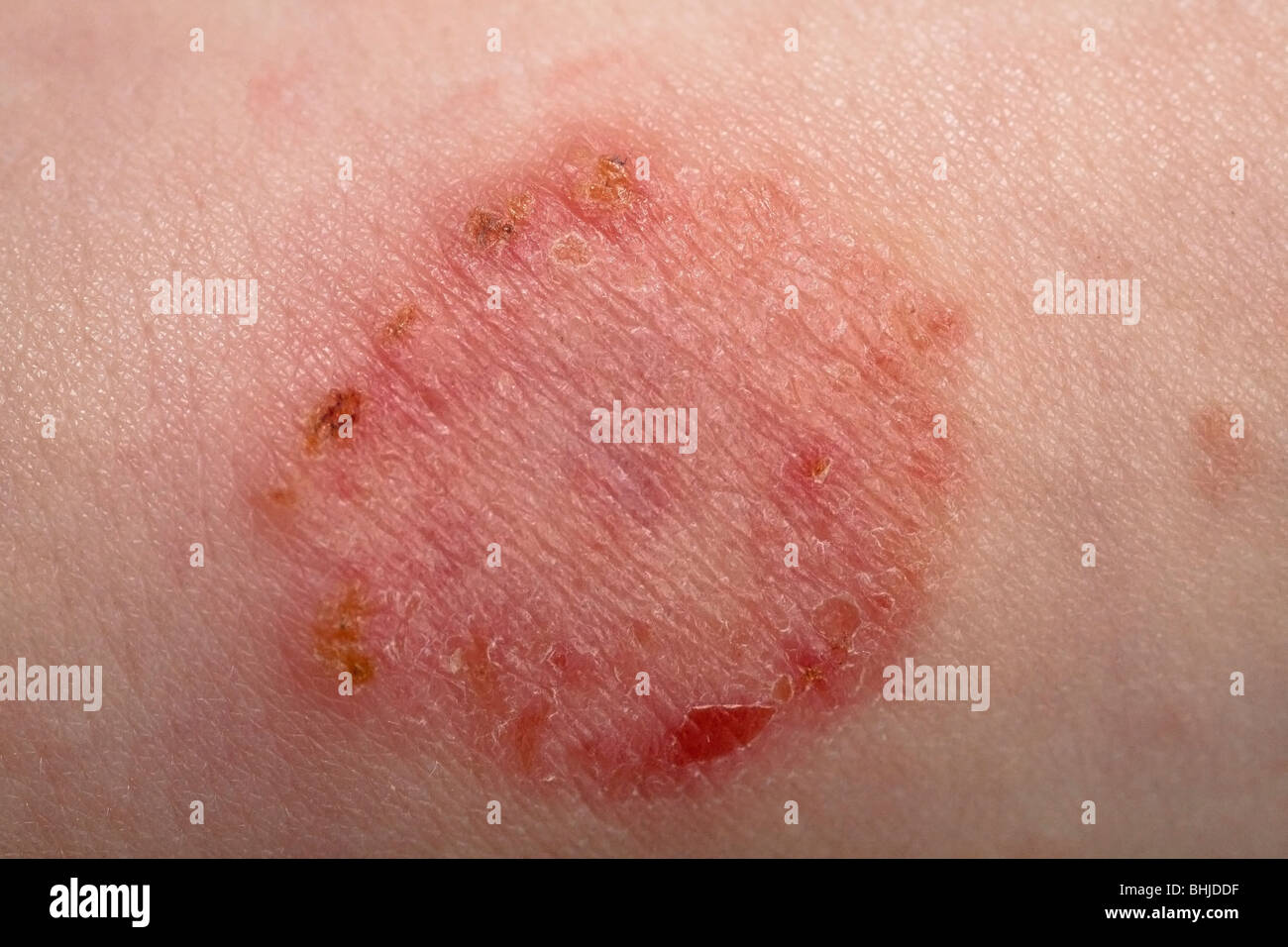 Tinea Corporis Arm Tinea Corporis Infection A Case Based Management