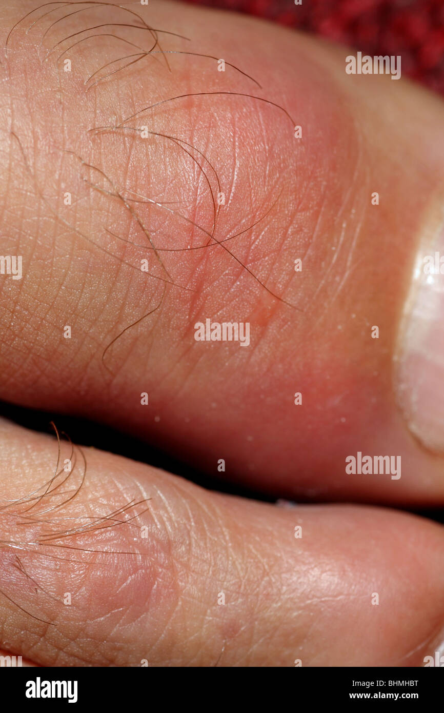 Großer zeh gicht -Fotos und -Bildmaterial in hoher Auflösung – Alamy