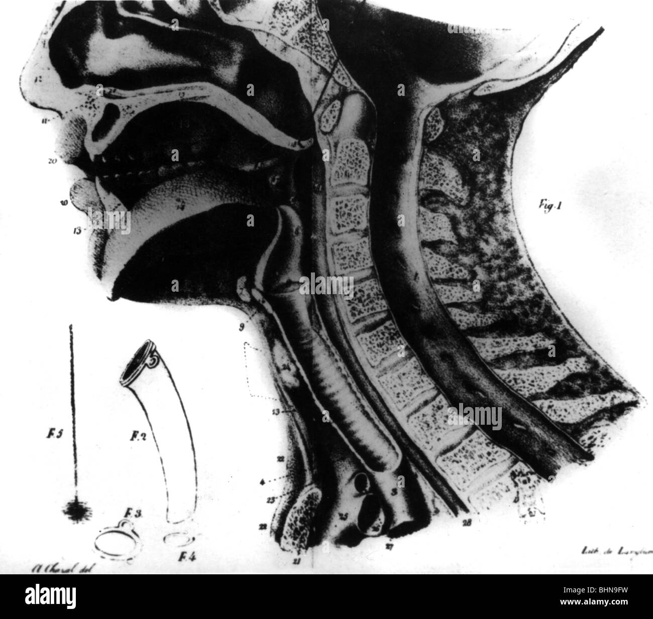 Tracheostomy Tracheotomy Stockfotos & Tracheostomy Tracheotomy Bilder ...