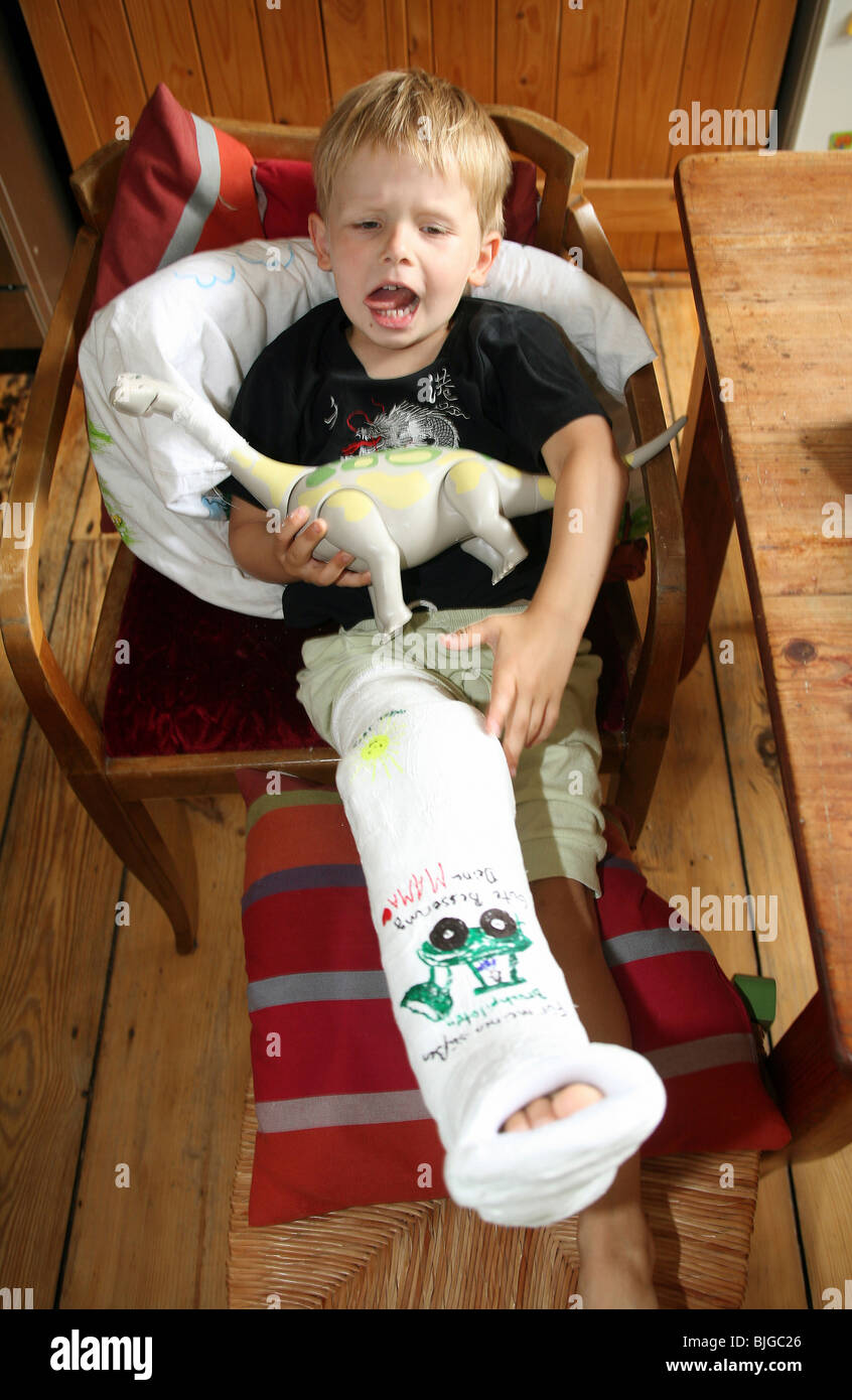 Beinbruch Gips Stockfotos und -bilder Kaufen - Alamy