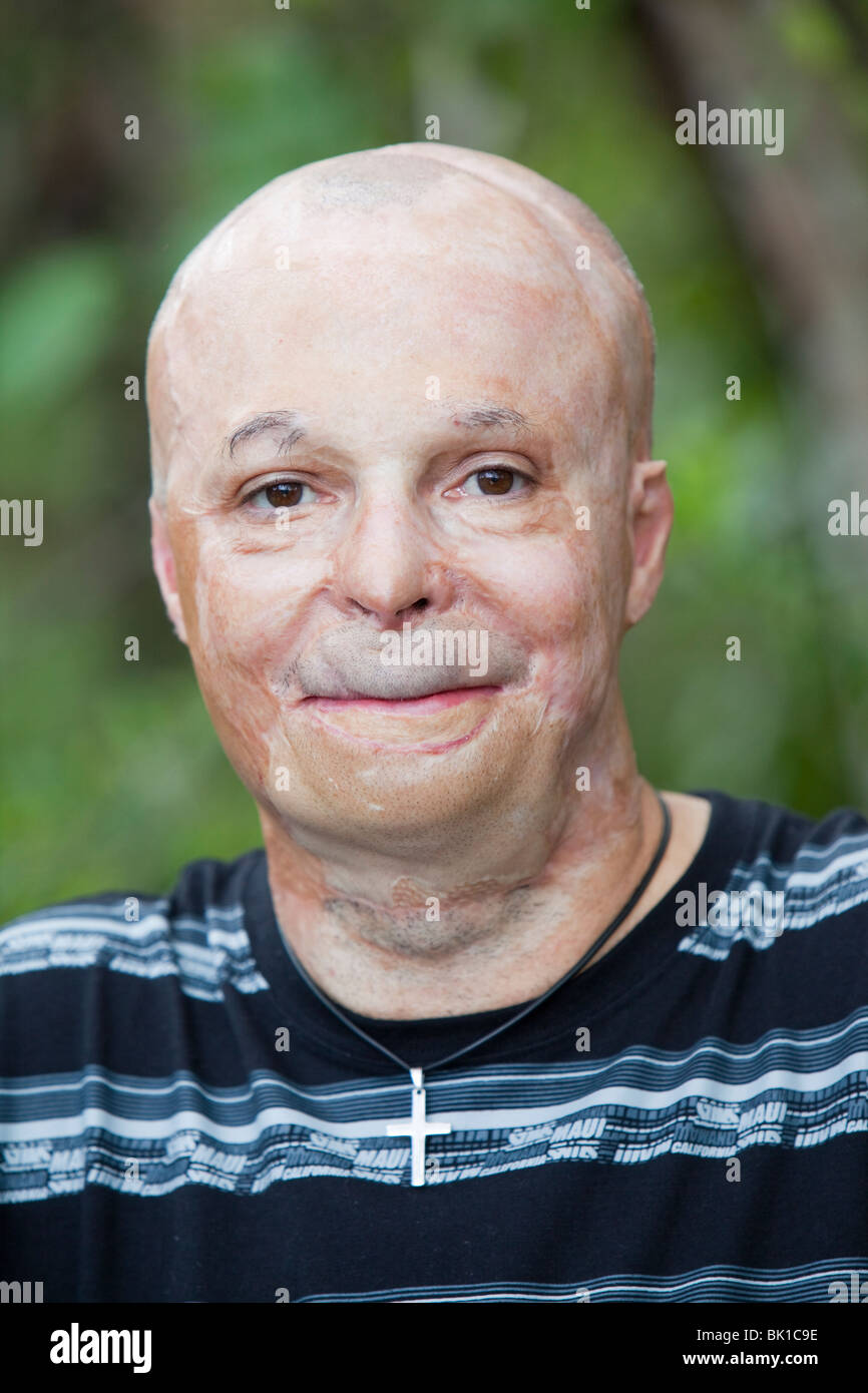 Disfigured face man -Fotos und -Bildmaterial in hoher Auflösung – Alamy