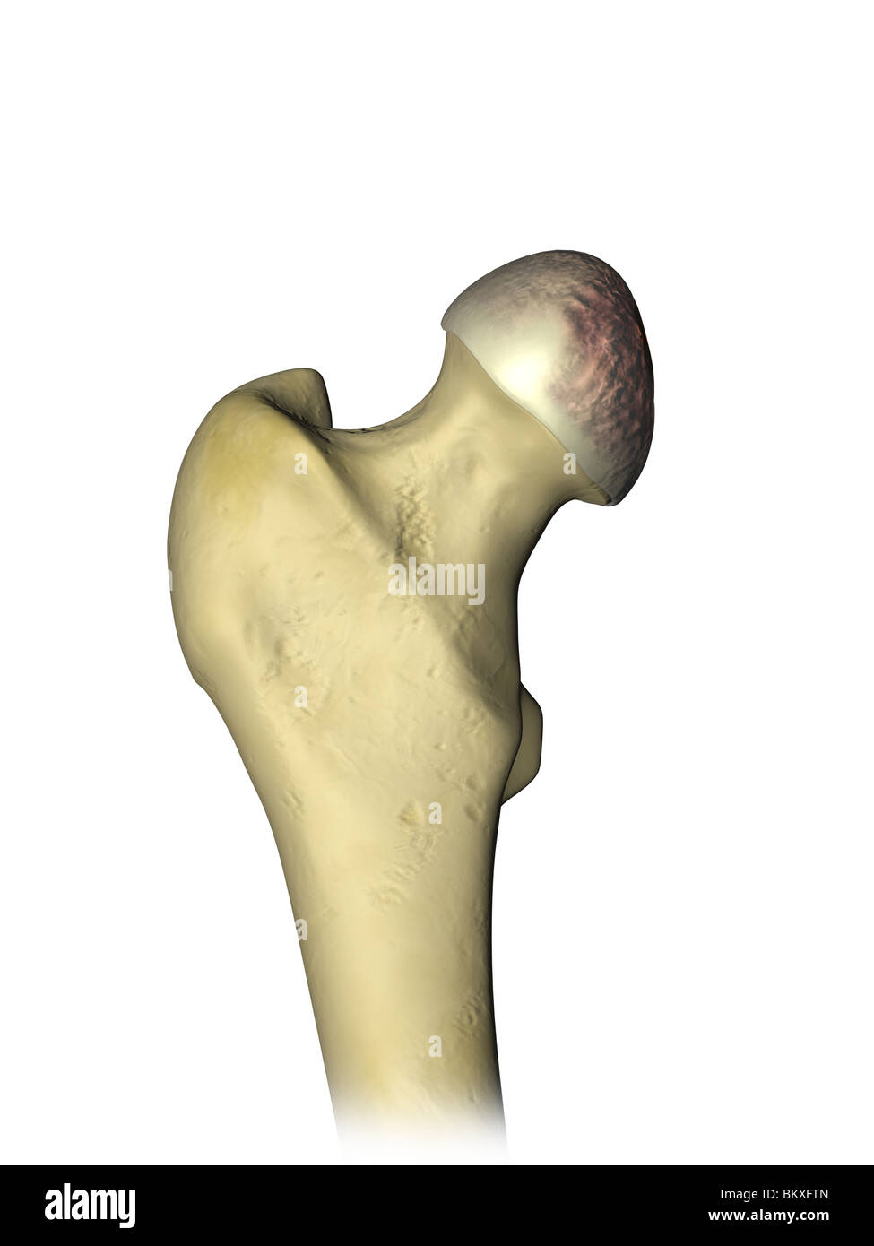 Femoral head -Fotos und -Bildmaterial in hoher Auflösung – Alamy