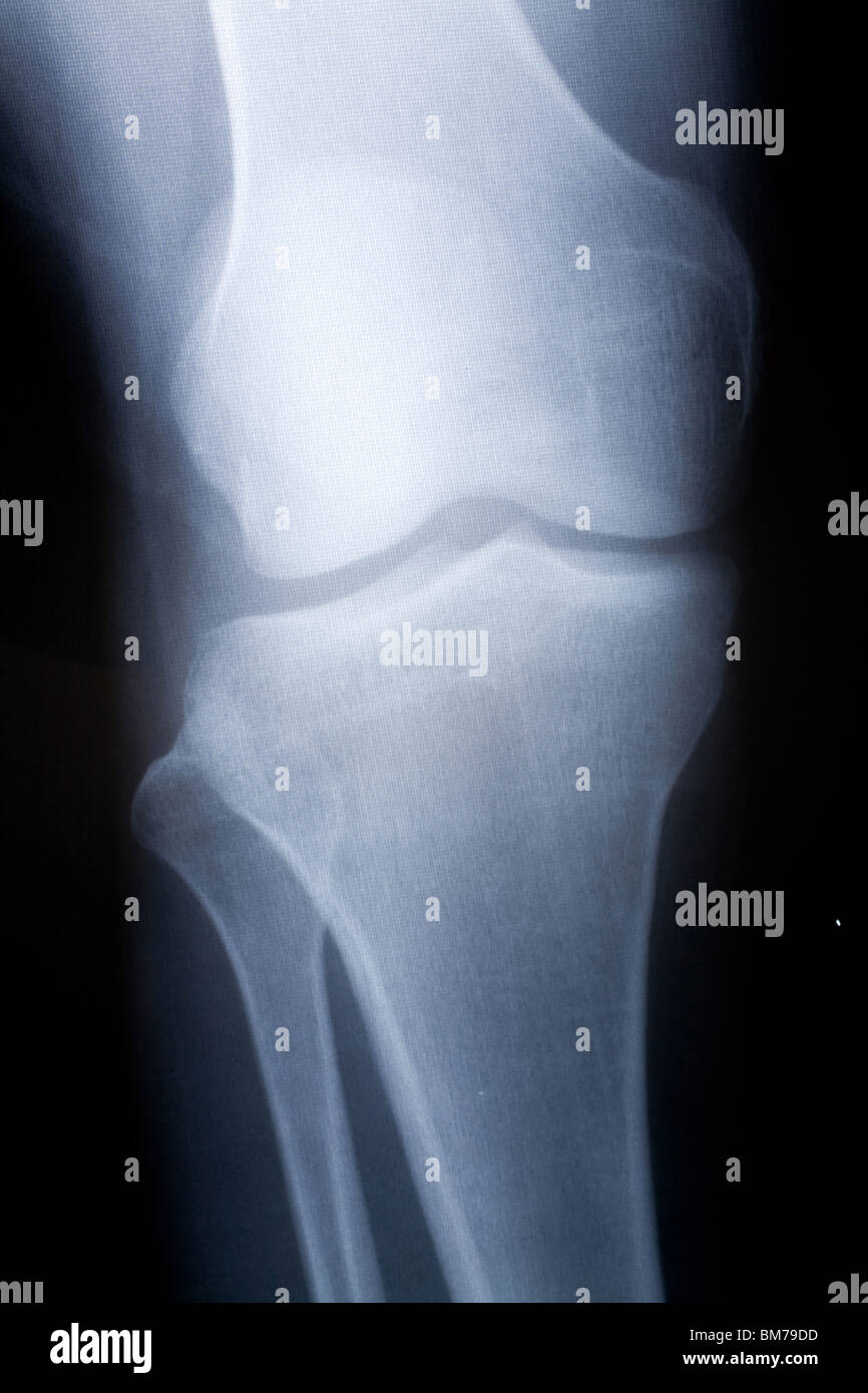 Knie Röntgen-Foto für den Hintergrund Stockfotografie - Alamy