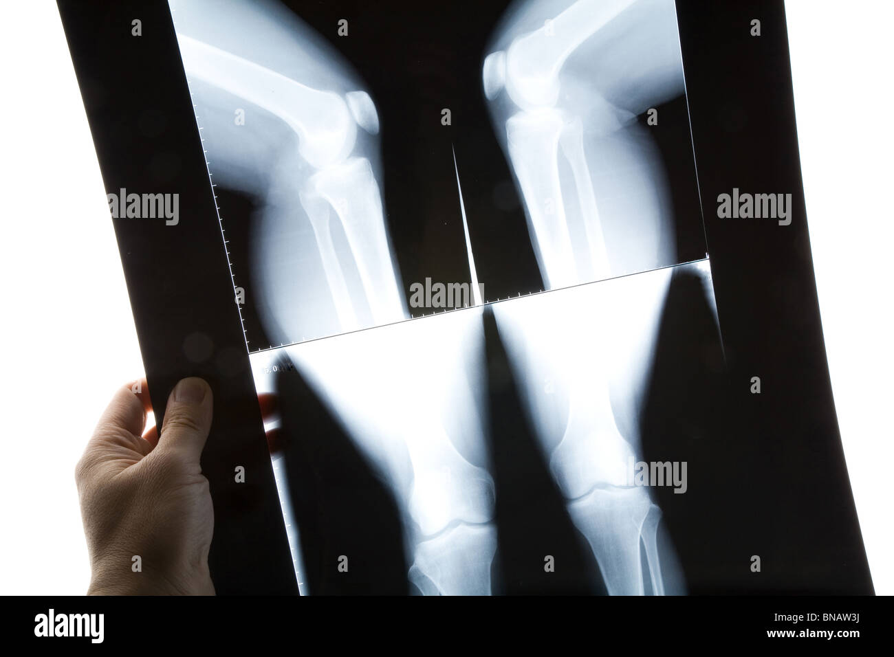 Knie röntgen -Fotos und -Bildmaterial in hoher Auflösung – Alamy
