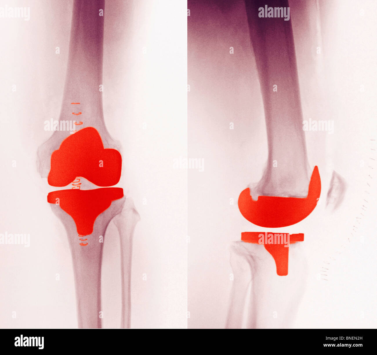 Knee replacement -Fotos und -Bildmaterial in hoher Auflösung – Alamy