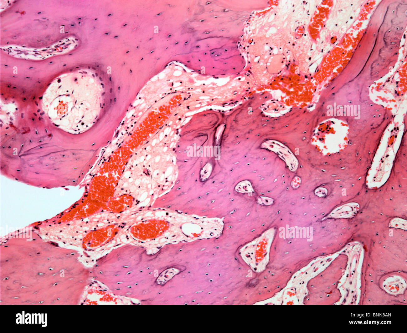 Osteoid osteom -Fotos und -Bildmaterial in hoher Auflösung – Alamy