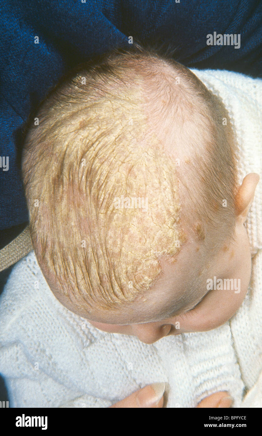 Baby mit Milchschorf Stockfotografie - Alamy