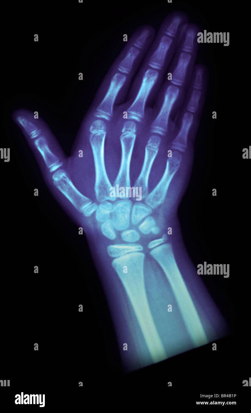 Hand anatomie röntgen -Fotos und -Bildmaterial in hoher Auflösung – Alamy