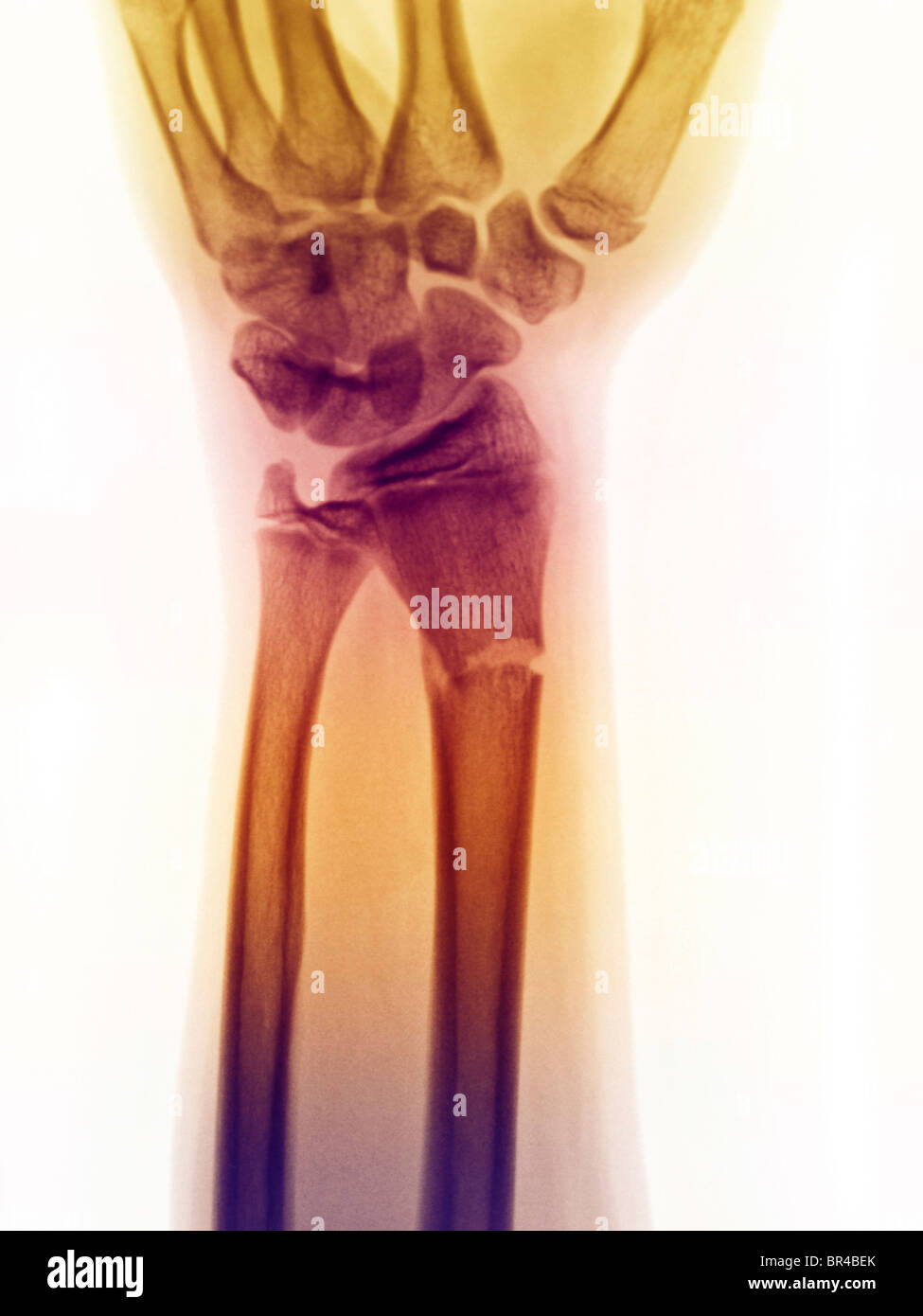 Unterarm Röntgen zeigen eine distale Radius Fraktur in ein 14 Jahre ...