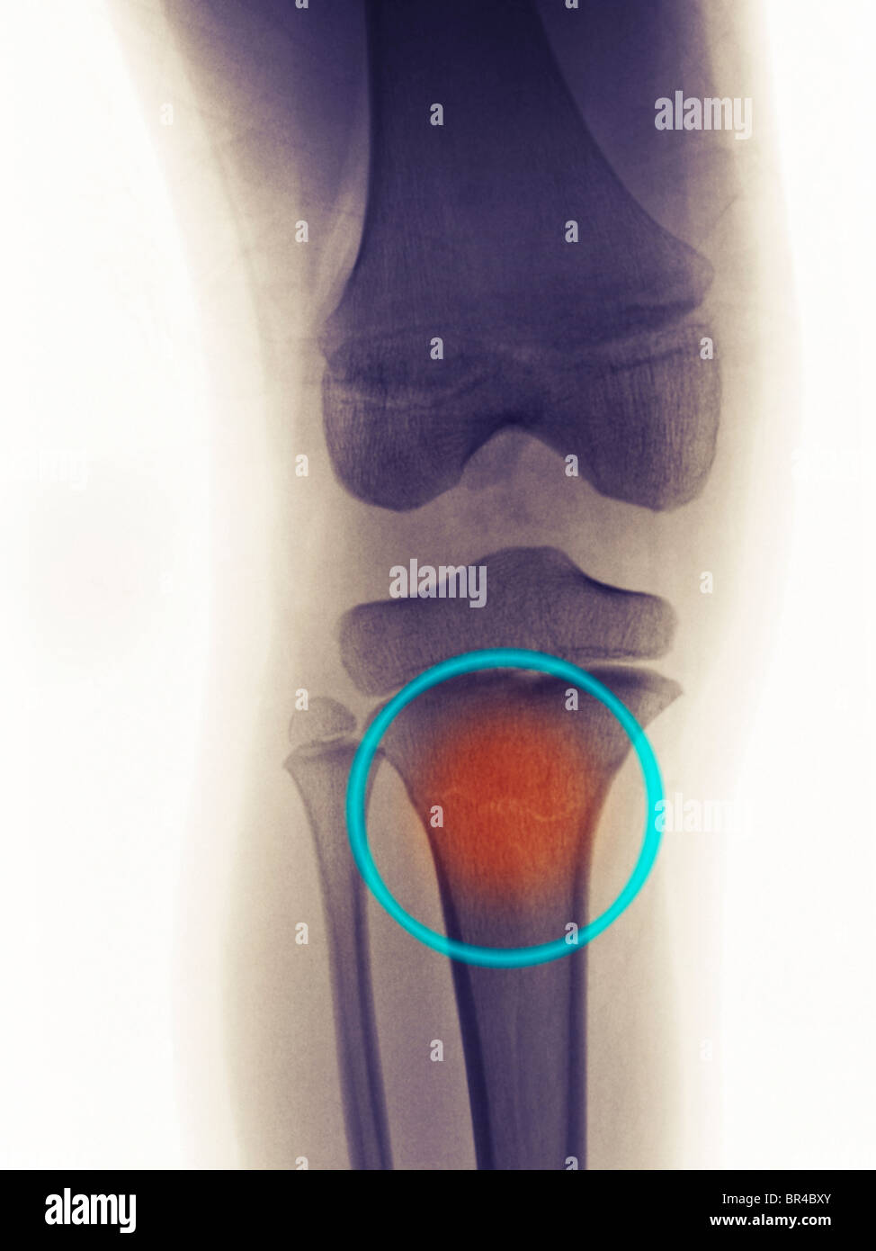 Proximalen Digitale Blockade Orientierungspunkte Und ...