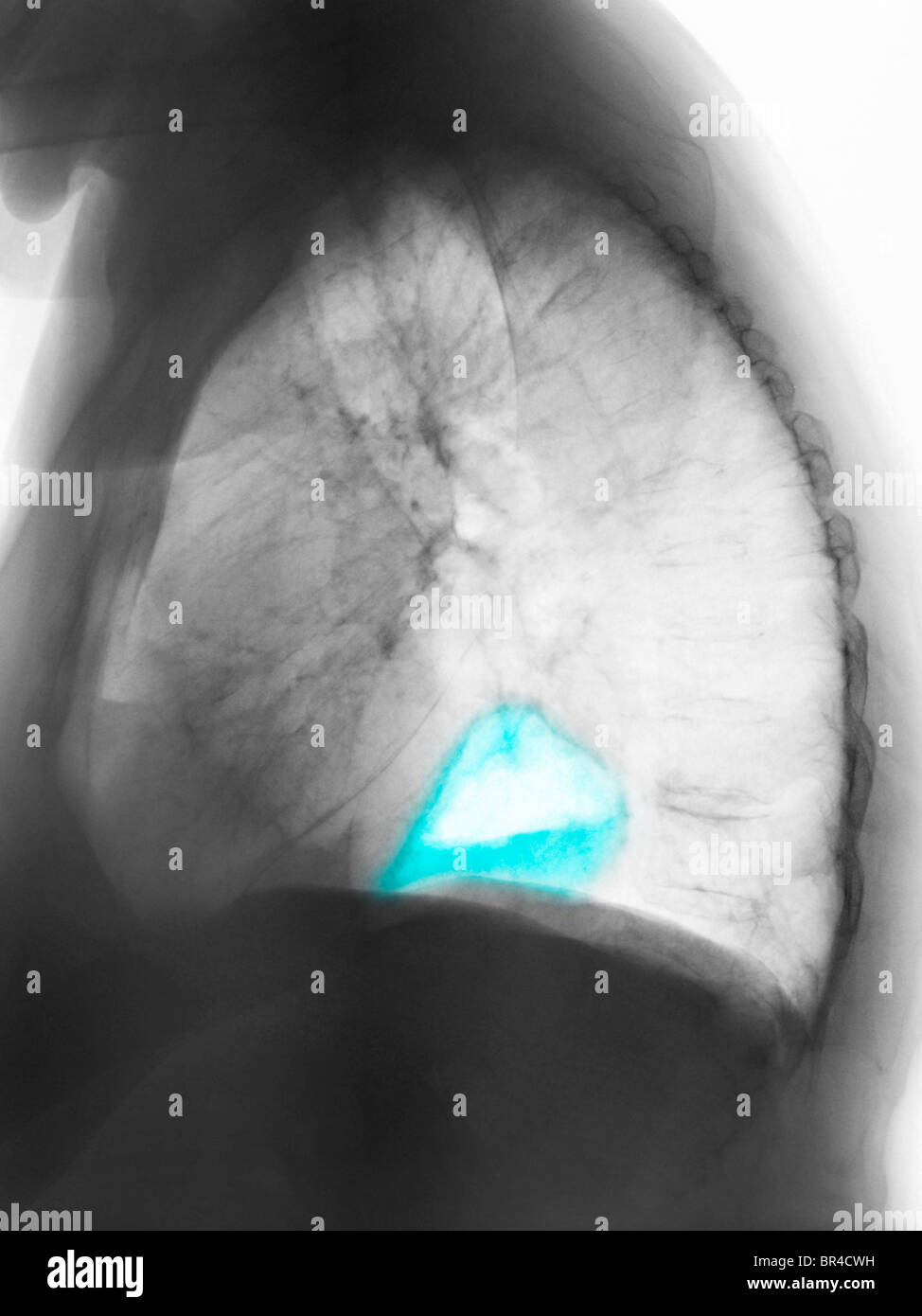 x-ray zeigt eine Hiatushernie in einer 82 Jahre alten person ...