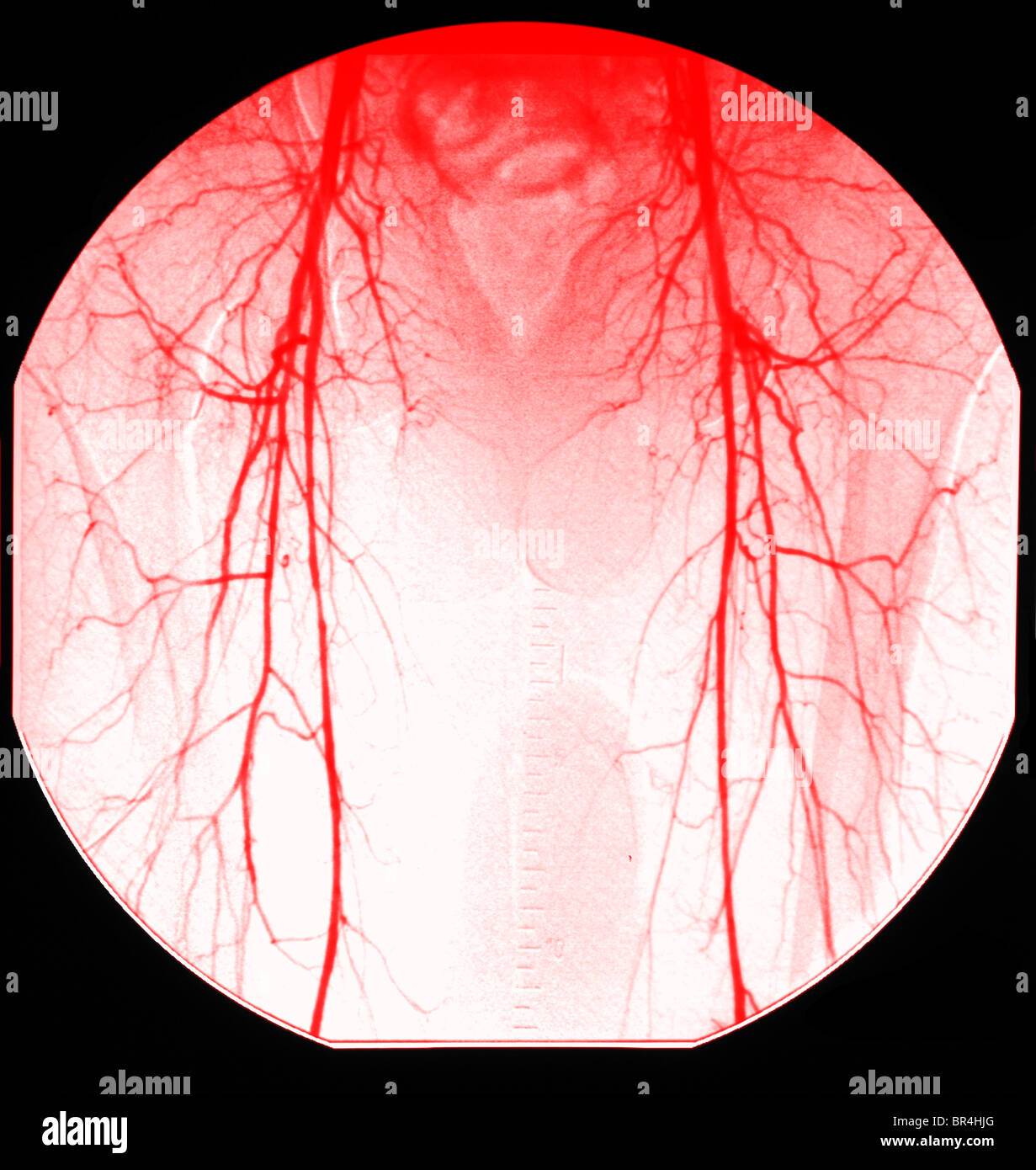 normale Aorta Angiogramm der Femoral Arterien an den Beinen ...