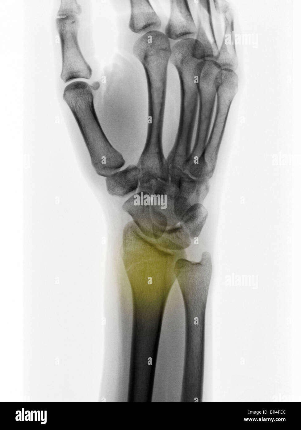 Unterarm Röntgen eine 29 Jahre alte Frau zeigt eine nicht verschobenen ...