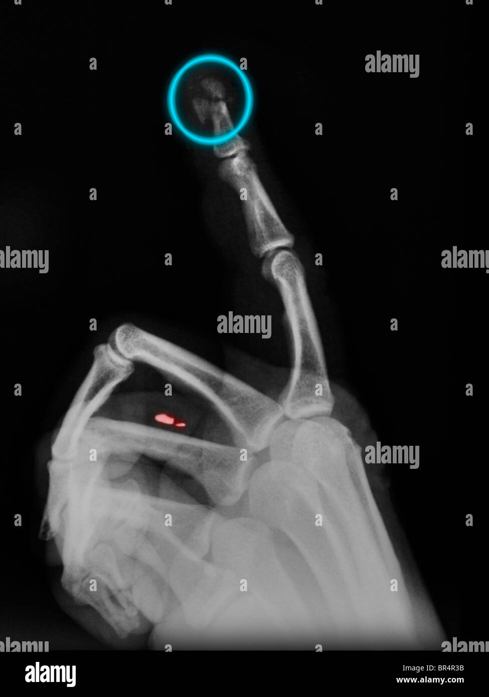 Röntgen der Hand ein 64 Jahre alter Mann, der seine Fingerspitze ...
