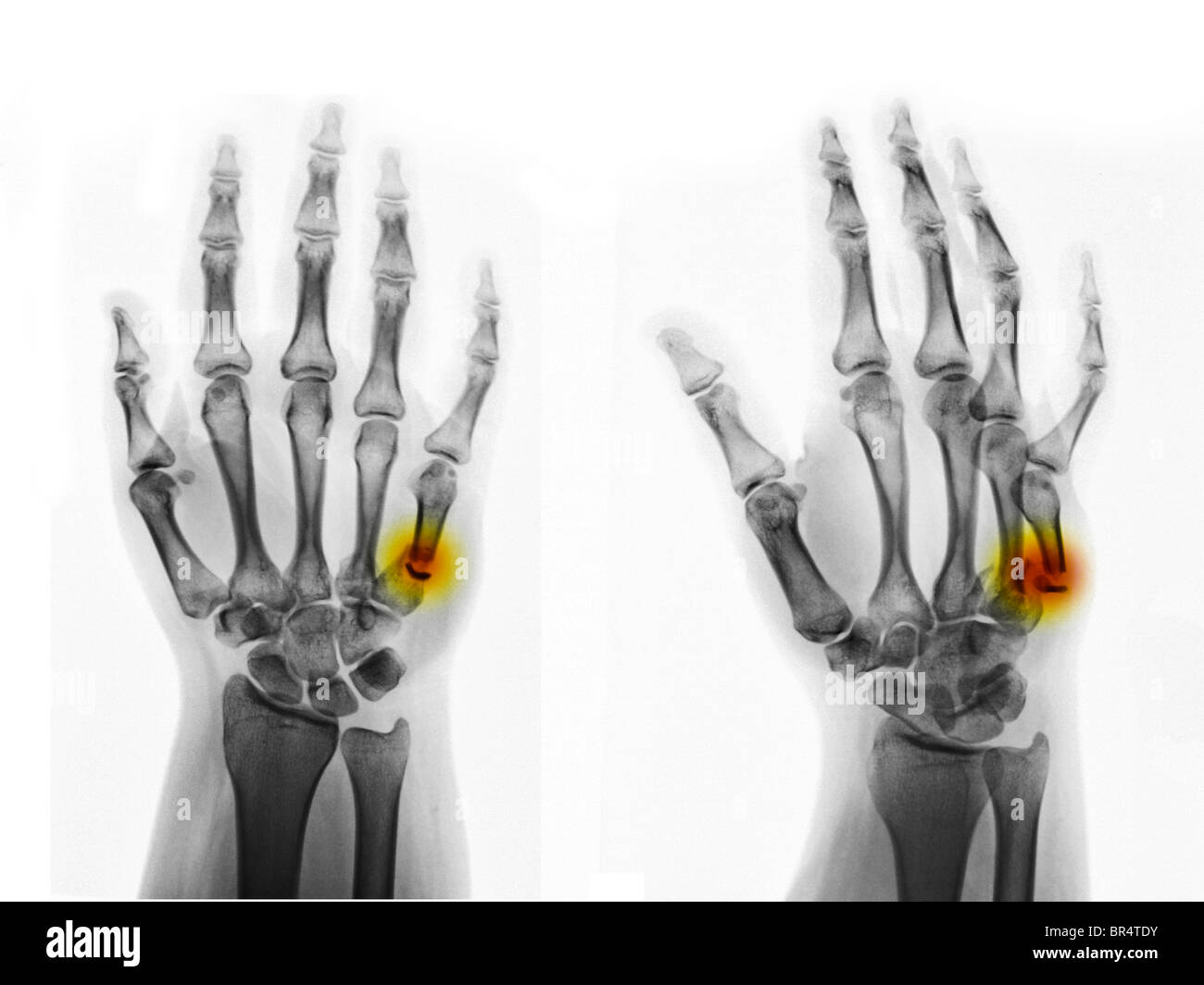 Hand Fracture Stockfotos & Hand Fracture Bilder - Seite 3 - Alamy