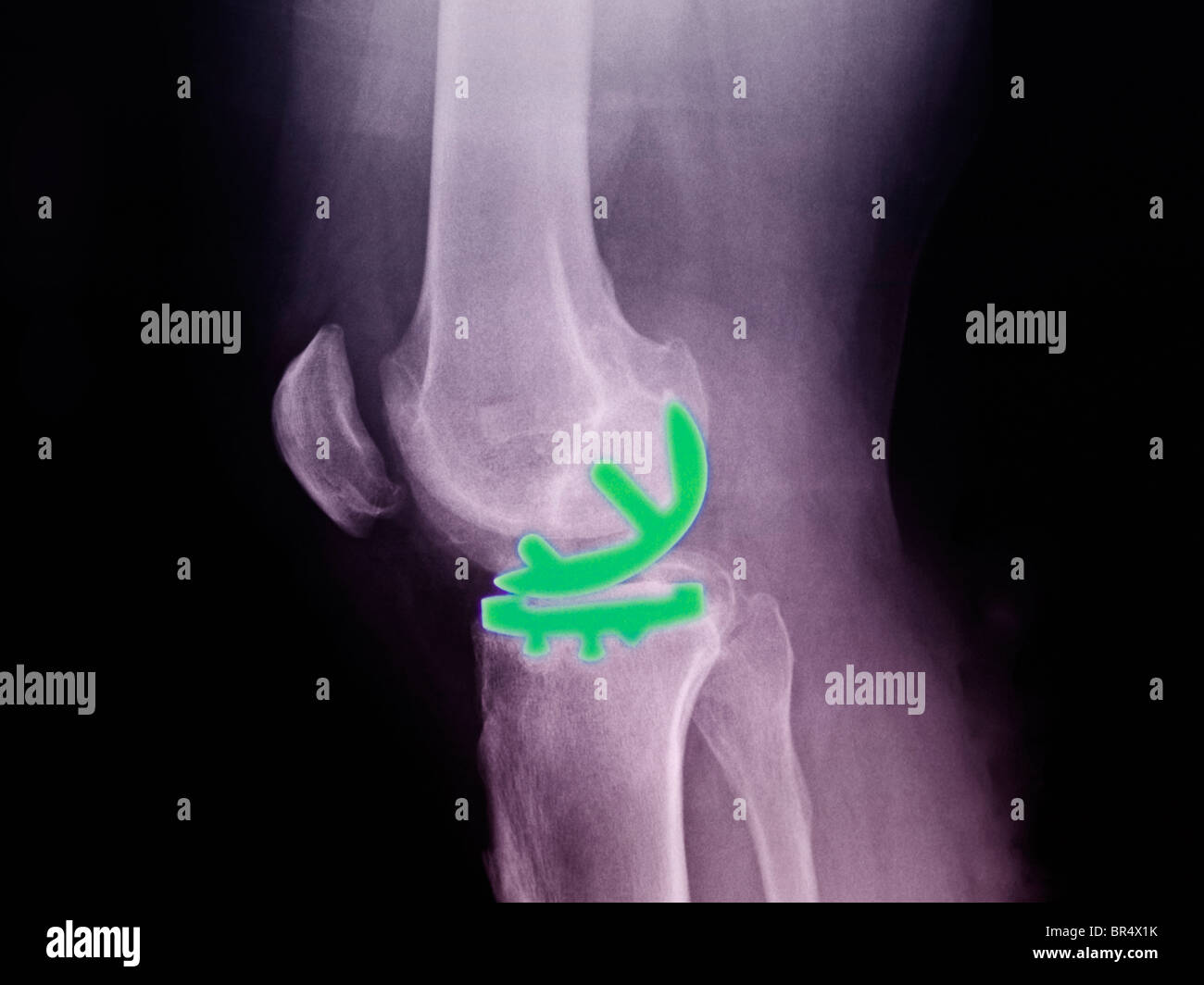 Medial Condyle Stockfotos und -bilder Kaufen - Alamy