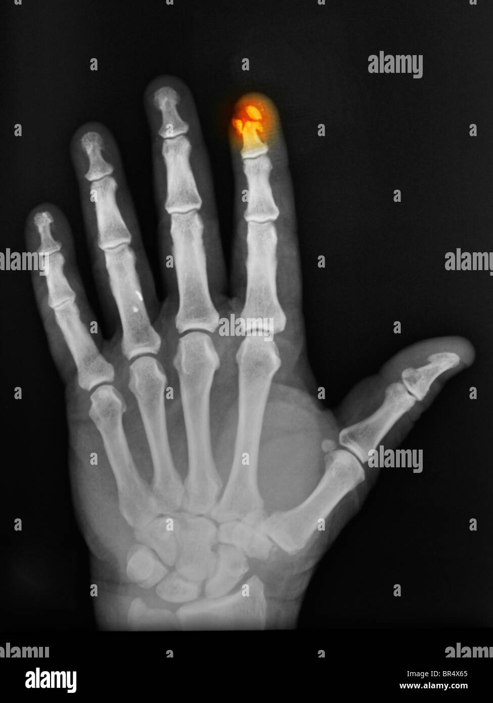 Ray Hand Broken Finger Stockfotos und -bilder Kaufen - Alamy