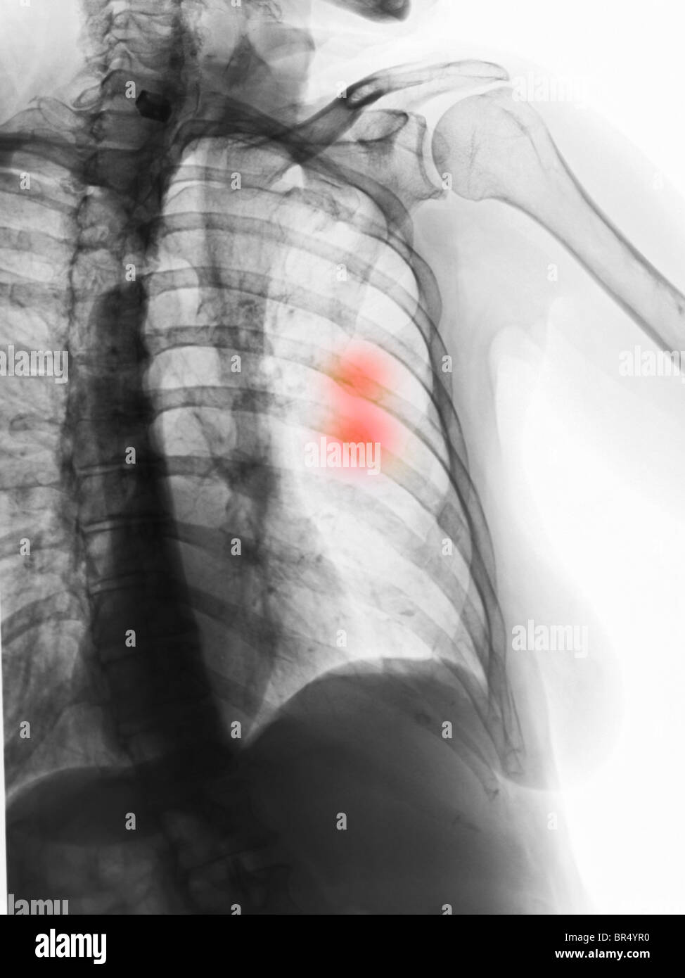 x-ray zeigt Rippenfrakturen in eine 53 jährige Frau Stockfotografie - Alamy