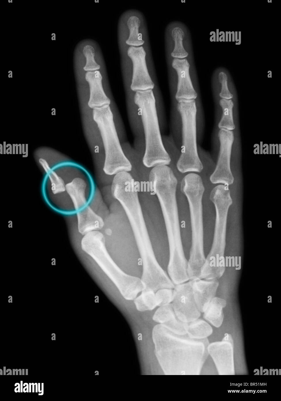 Hand Röntgen eine 36 jährige Frau, die eine Verschiebung der distalen ...