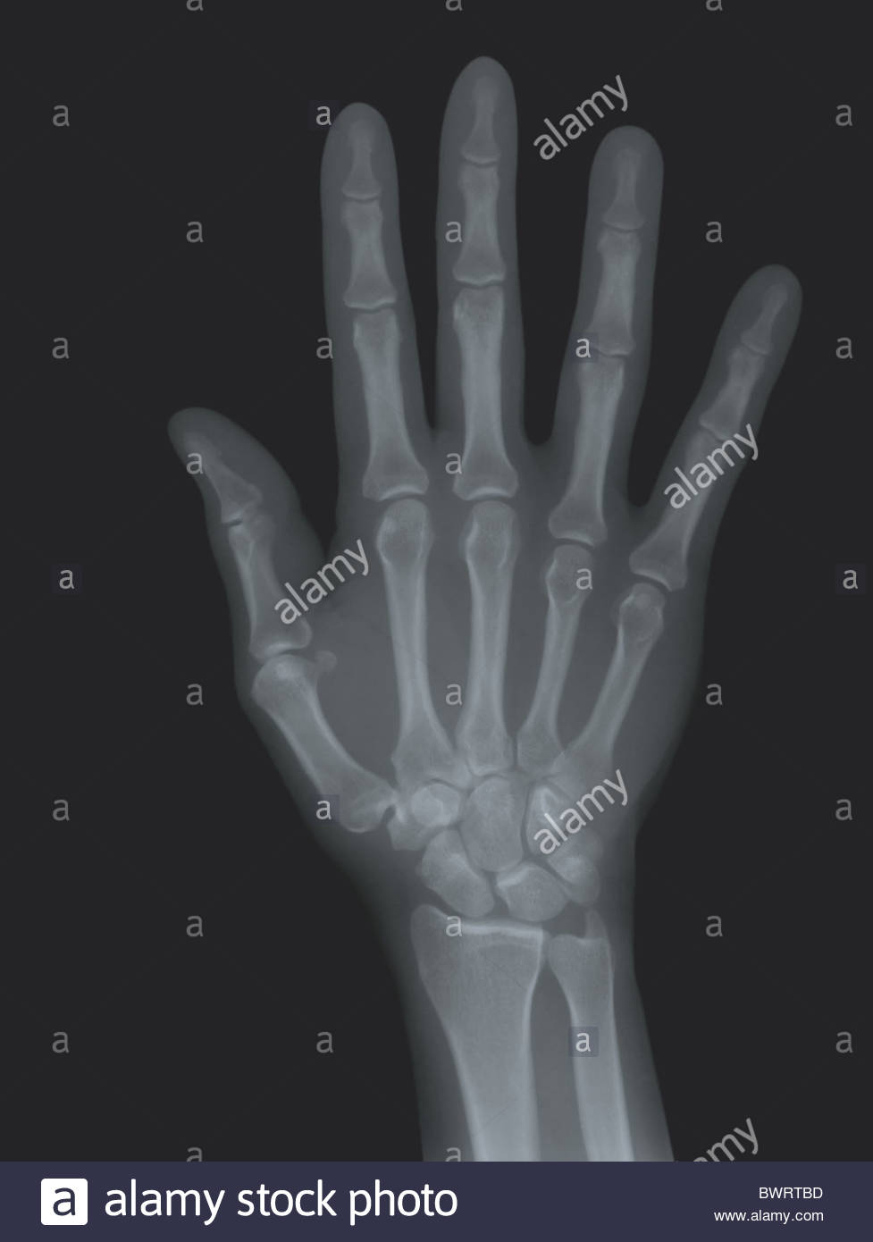 Arthritis Hands Xray Stockfotos & Arthritis Hands Xray Bilder - Alamy