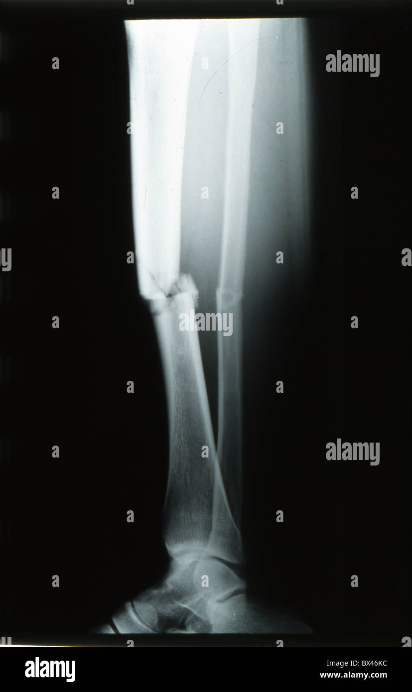 Bein Bruch Fraktur Knochen Pause Pause Bruch Bein Röntgen Röntgen Bild ...