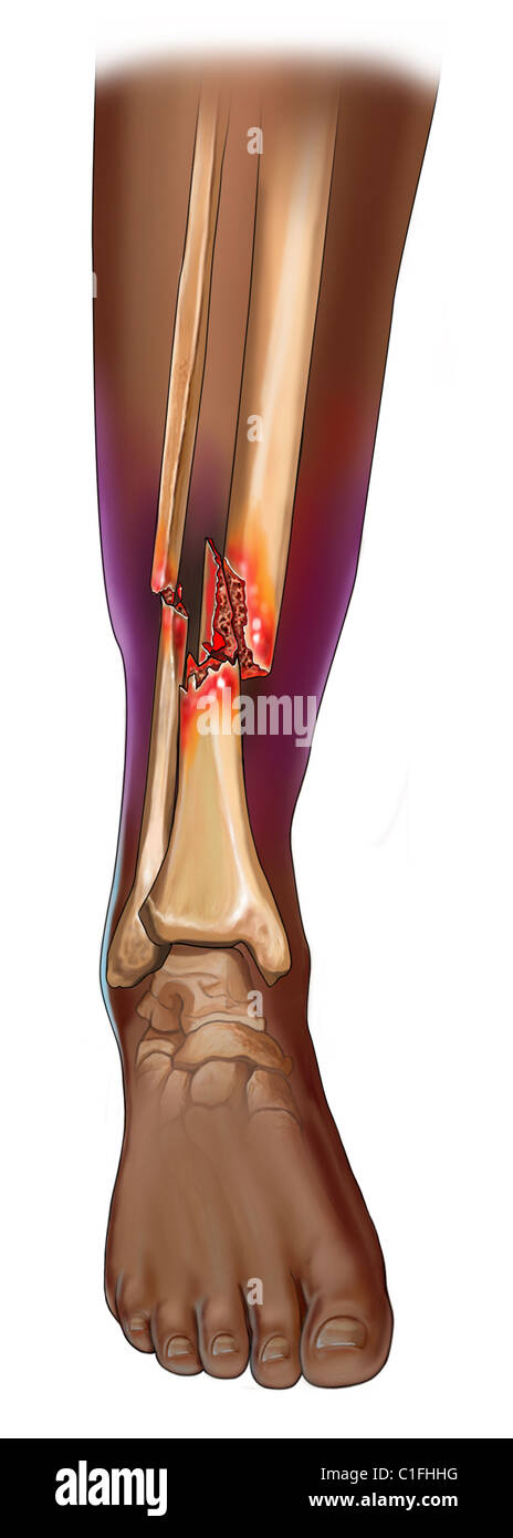 Tibial Fracture Stockfotos und -bilder Kaufen - Alamy