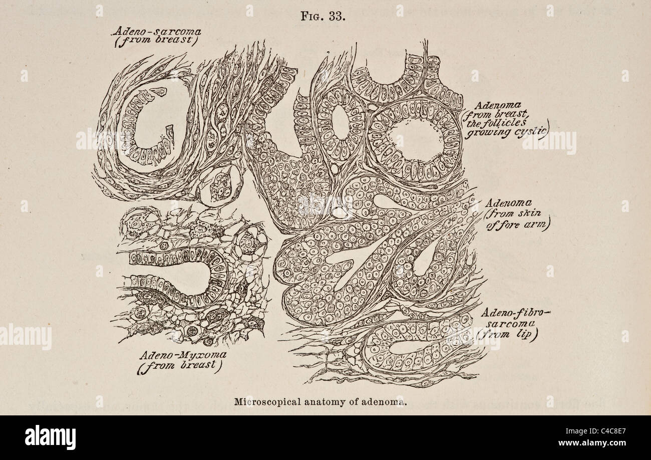 Abbildung der mikroskopischen Anatomie der Adenom ca. 1881 ...