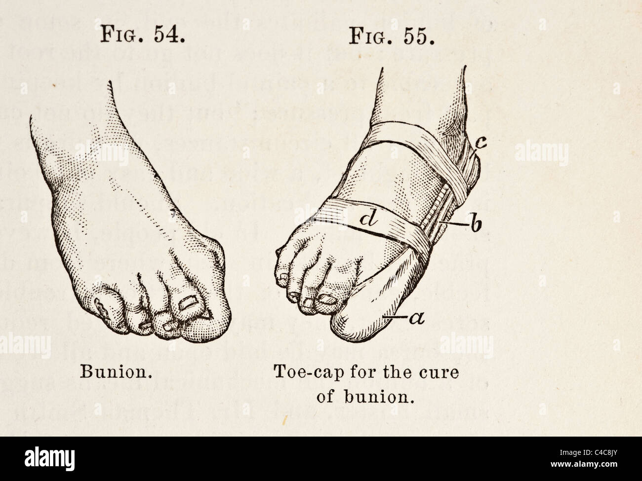 Antike medizinische Illustration der Ballen ca. 1881 Stockfotografie ...